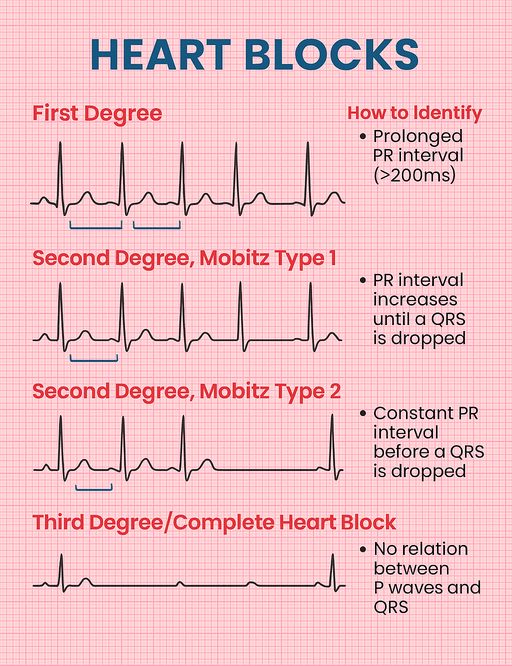 3. Arrhythmias - PASSMAP
